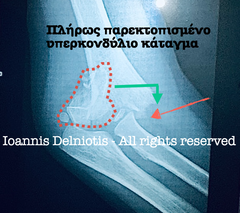 Υπερκονδύλιο κάταγμα αγκώνα σε παιδιά - Ιωάννης Δελνιώτης