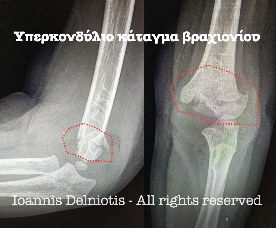 Υπερκονδύλιο κάταγμα αγκώνα σε παιδιά - Ιωάννης Δελνιώτης