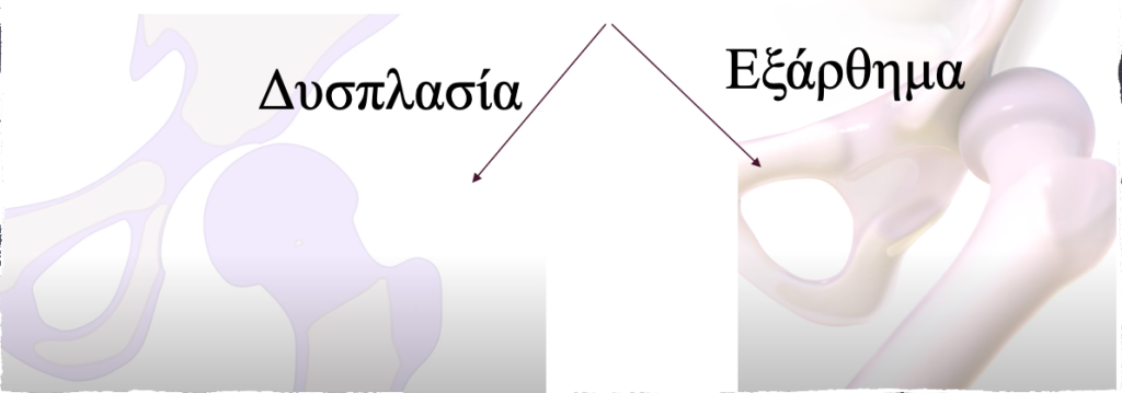 Δυσπλασία Ισχίου σε Παιδιά - Ιωάννης Δελνιώτης